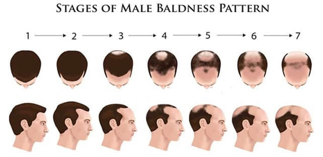 Male Pattern Baldness: Causes and Solutions - A Comprehensive Guide ...